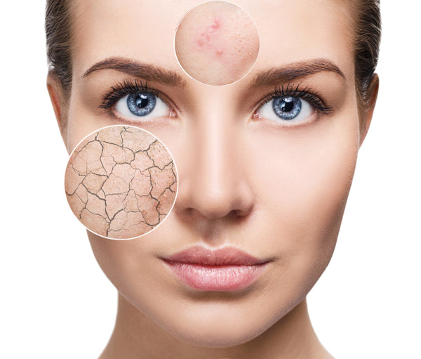 Gemengde huid – BeautyMonkey